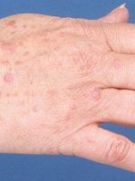 Liken Planus Nedir? Neden Olur ve Tedavisi Nasıldır?